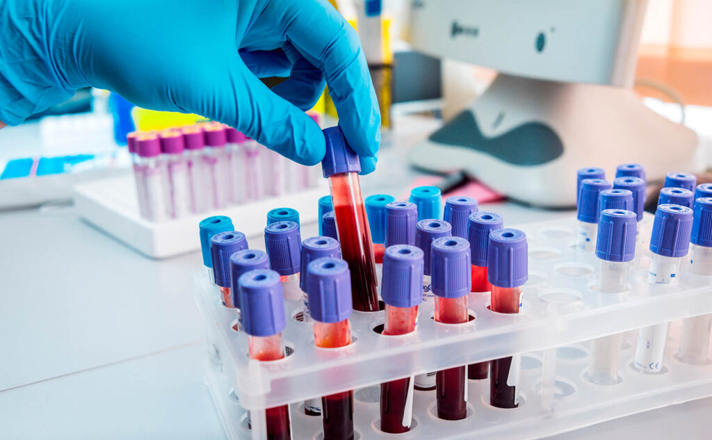 AI Blood Test Analyzer Free | Expert Lab Test Interpretation